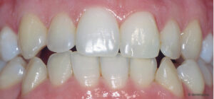 Der Zahnhalteapparat - Stoßdämpfer für unsere Zähne - Blog Zahnputzladen